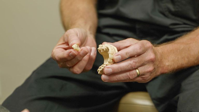 Dental Crowns | Dentist in Lebanon, Indiana | Dr. Dwight B. Lee